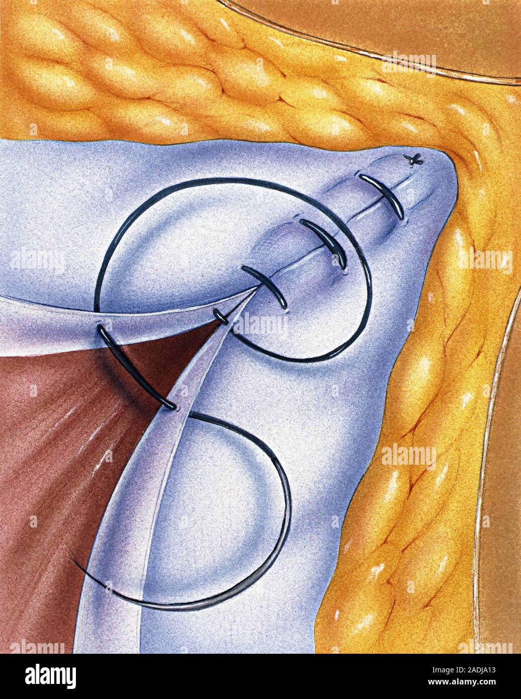 Wound suturing. Artwork of the suturing of the lining (blue) of an ...