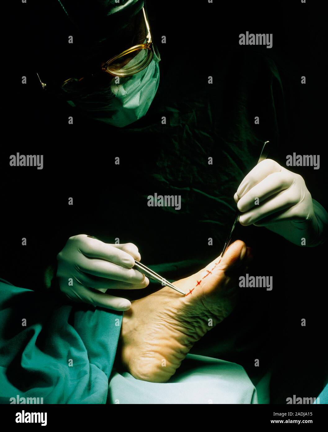 Orthopaedic foot surgery. View of an orthopaedic surgeon using forceps ...