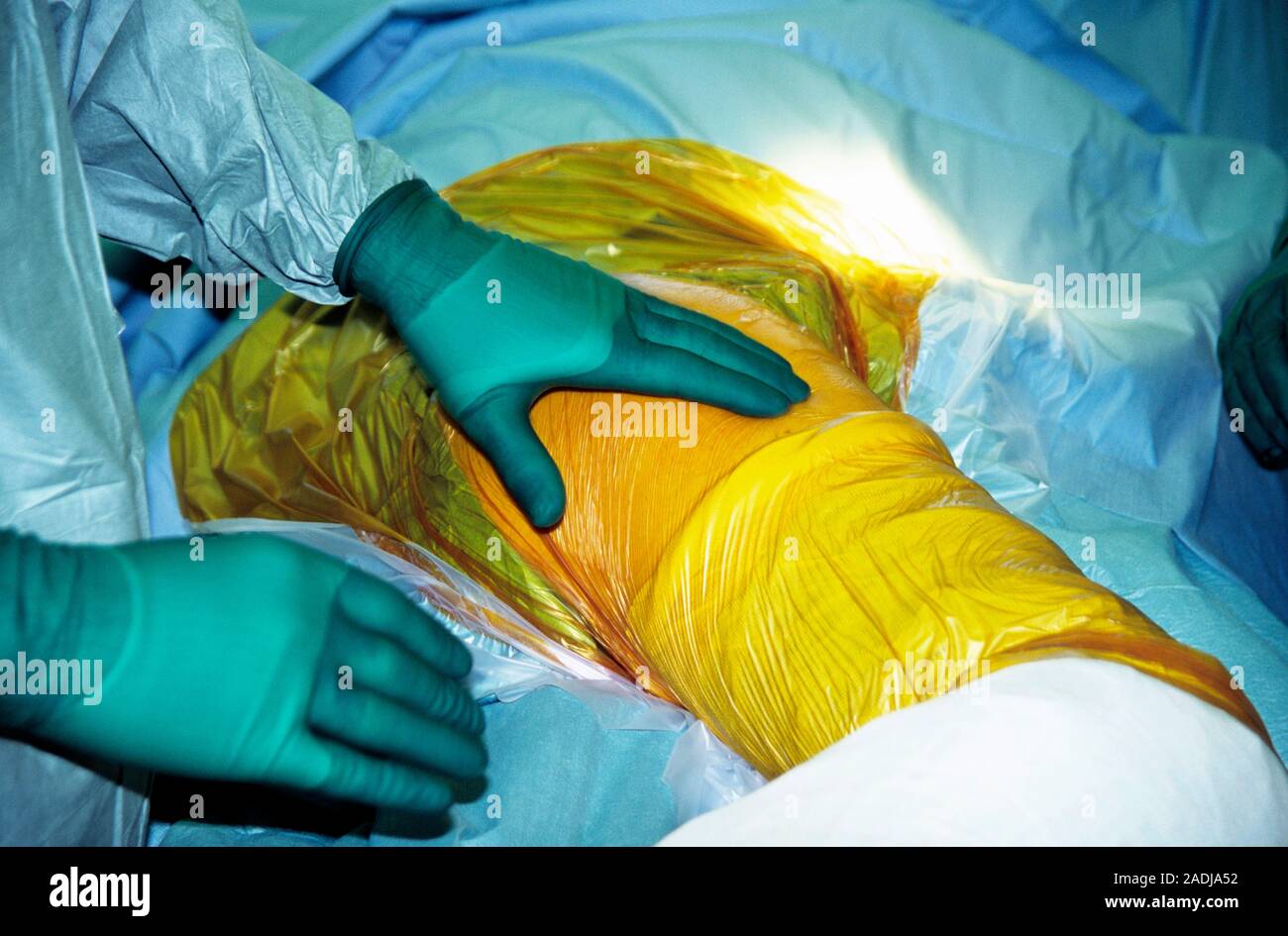 Hip replacement surgery. Image 2 of 30. Patient on an operating table ...