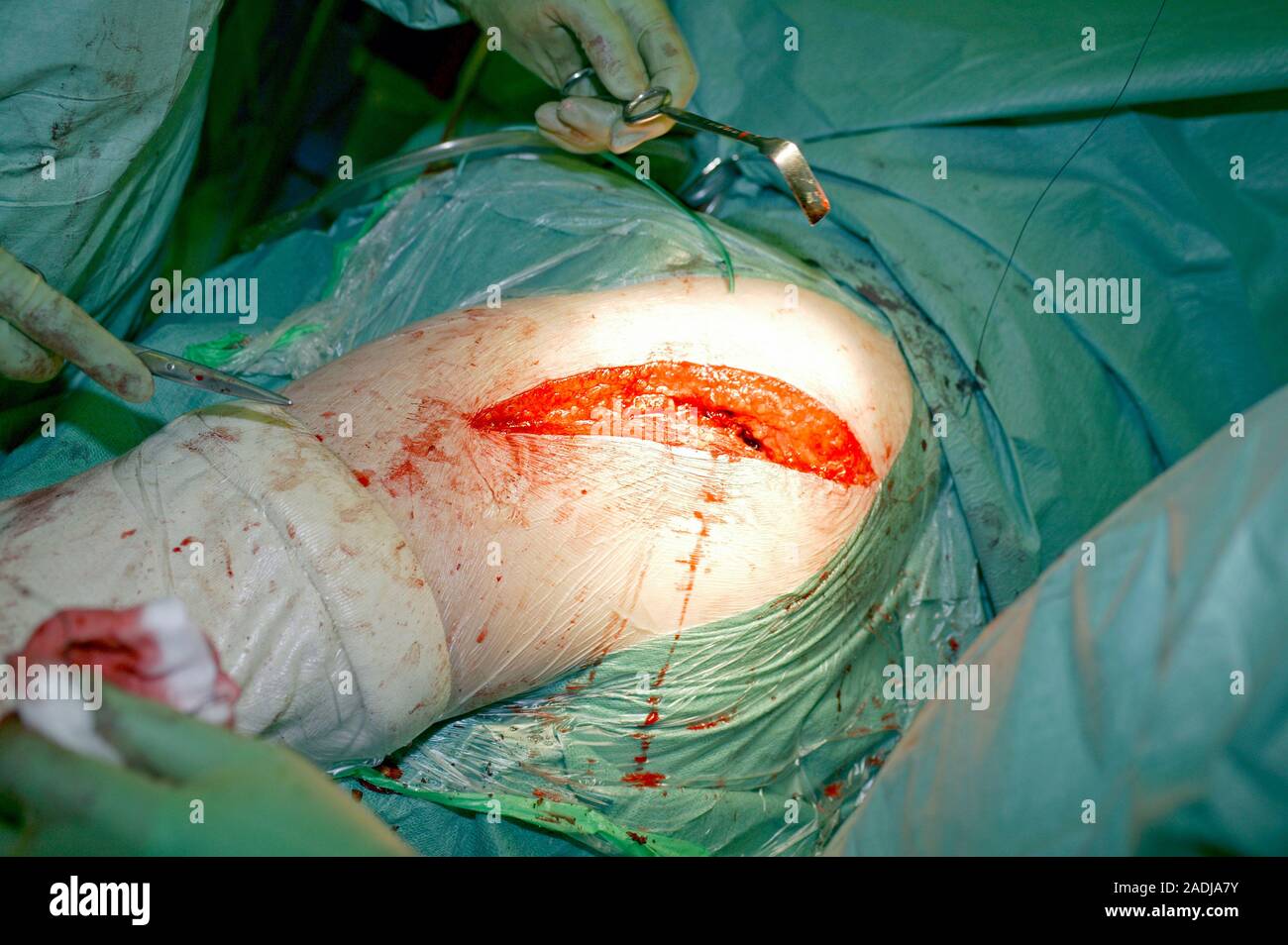 MODEL RELEASED. Hip replacement surgery. Image 9 of 9. Surgeon sewing ...