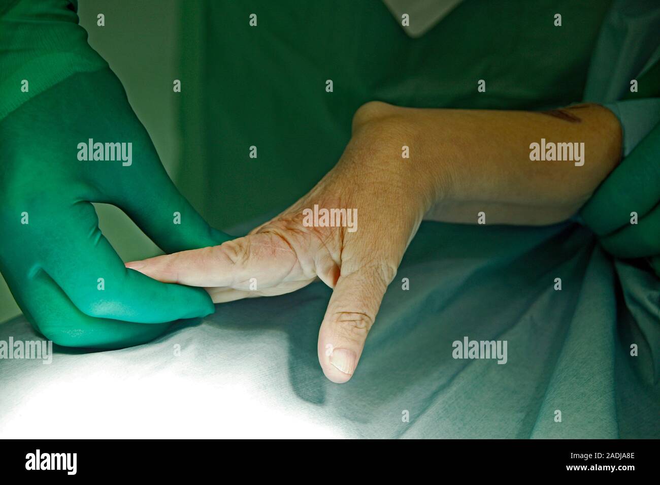 MODEL RELEASED. Carpal tunnel syndrome surgery. Image 1 of 13. Surgeon ...