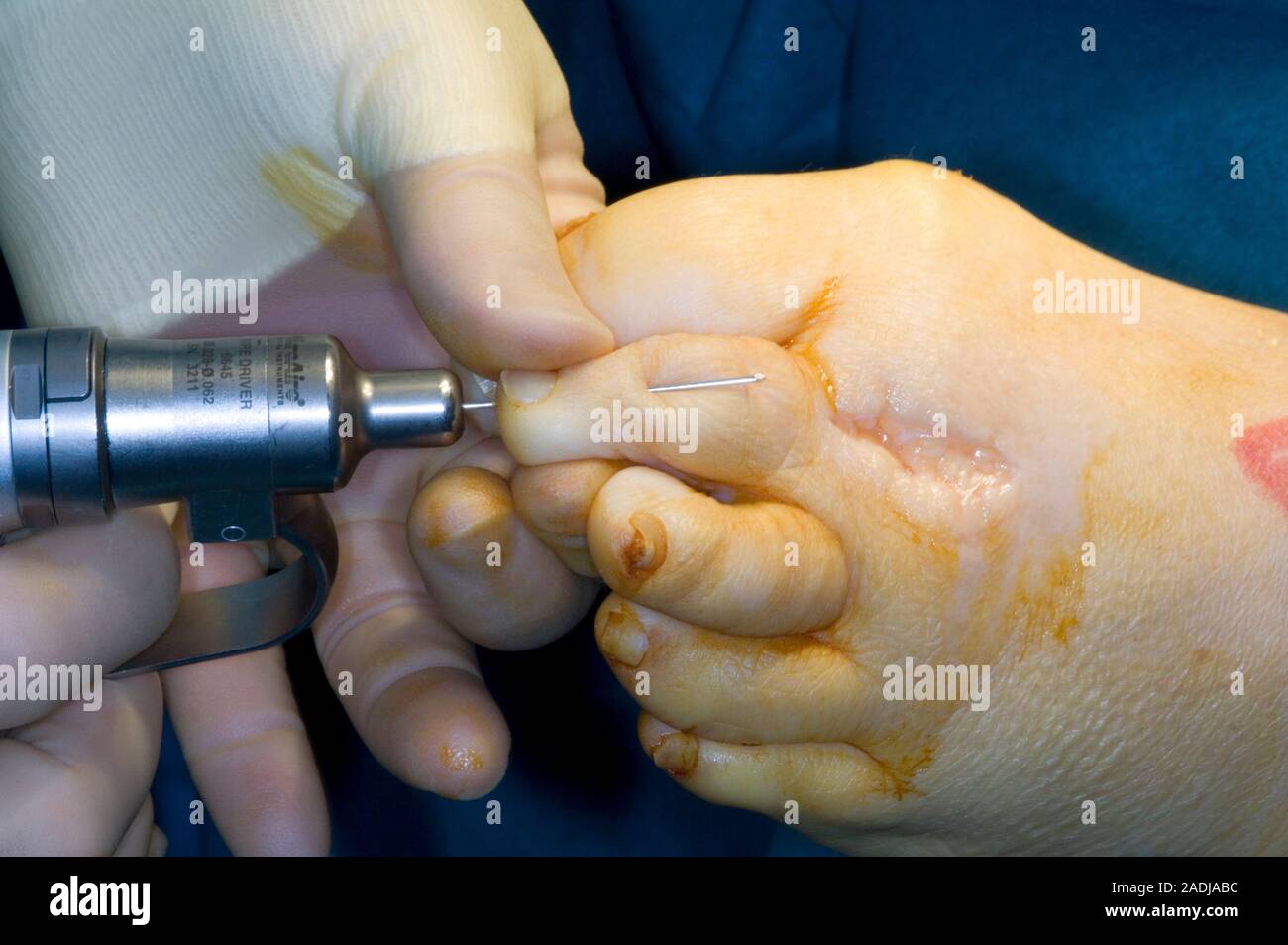 Bunion surgery. Image 3 of 12. Foot with a bunion undergoing chevron ...
