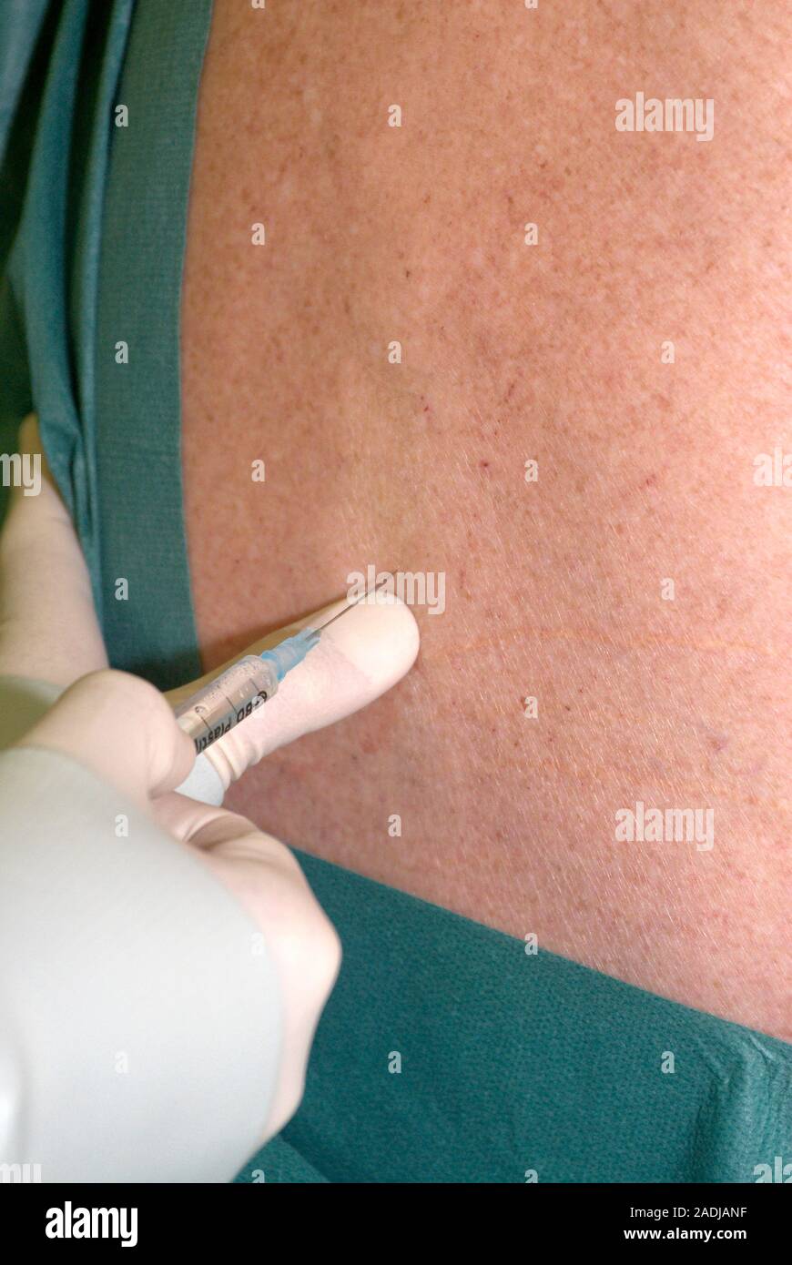 MODEL RELEASED. Epidural anaesthetic. Image 1 of 4. Anaesthetist ...