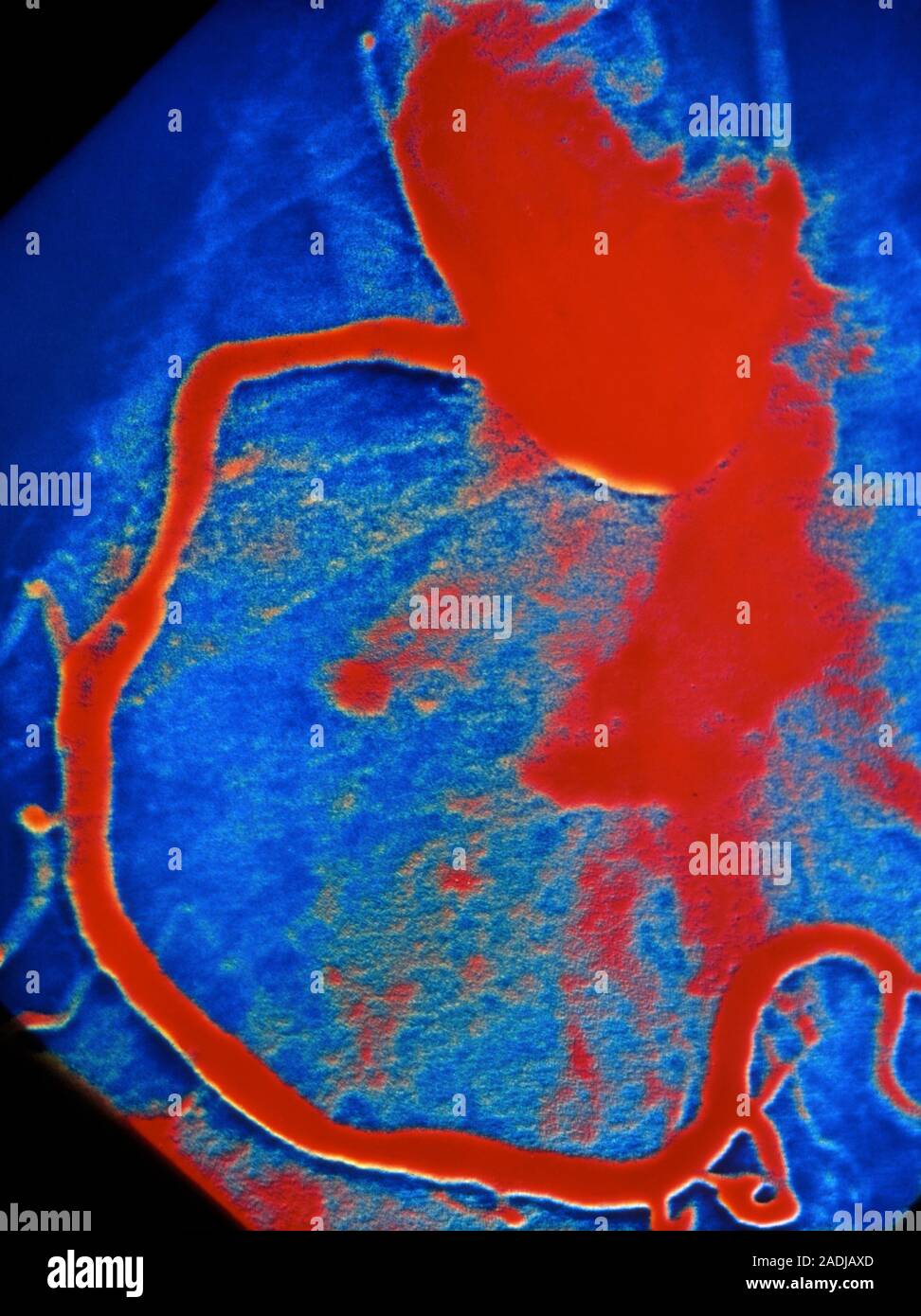 Post-angioplasty. Coloured angiogram taken after a percutaneous ...