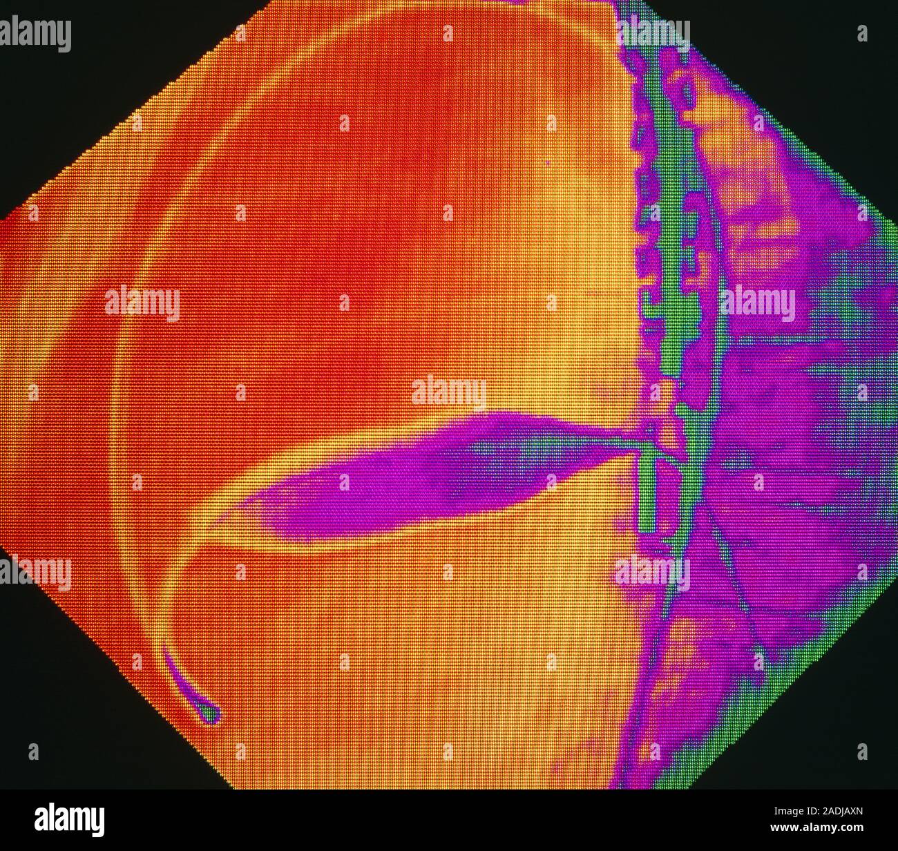 Cardiac angioplasty. Coloured angiogram (X-ray) of an inflated balloon ...