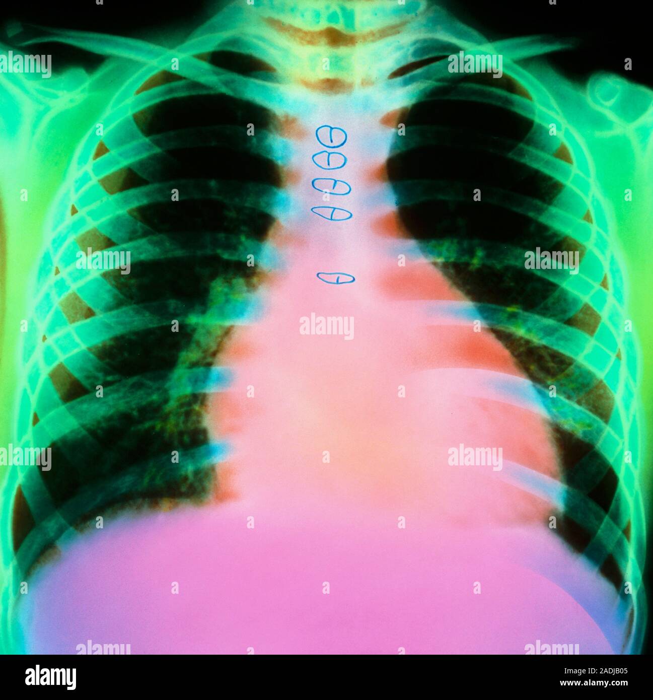 Transplanted heart. Coloured chest X-ray of a child with a transplanted ...