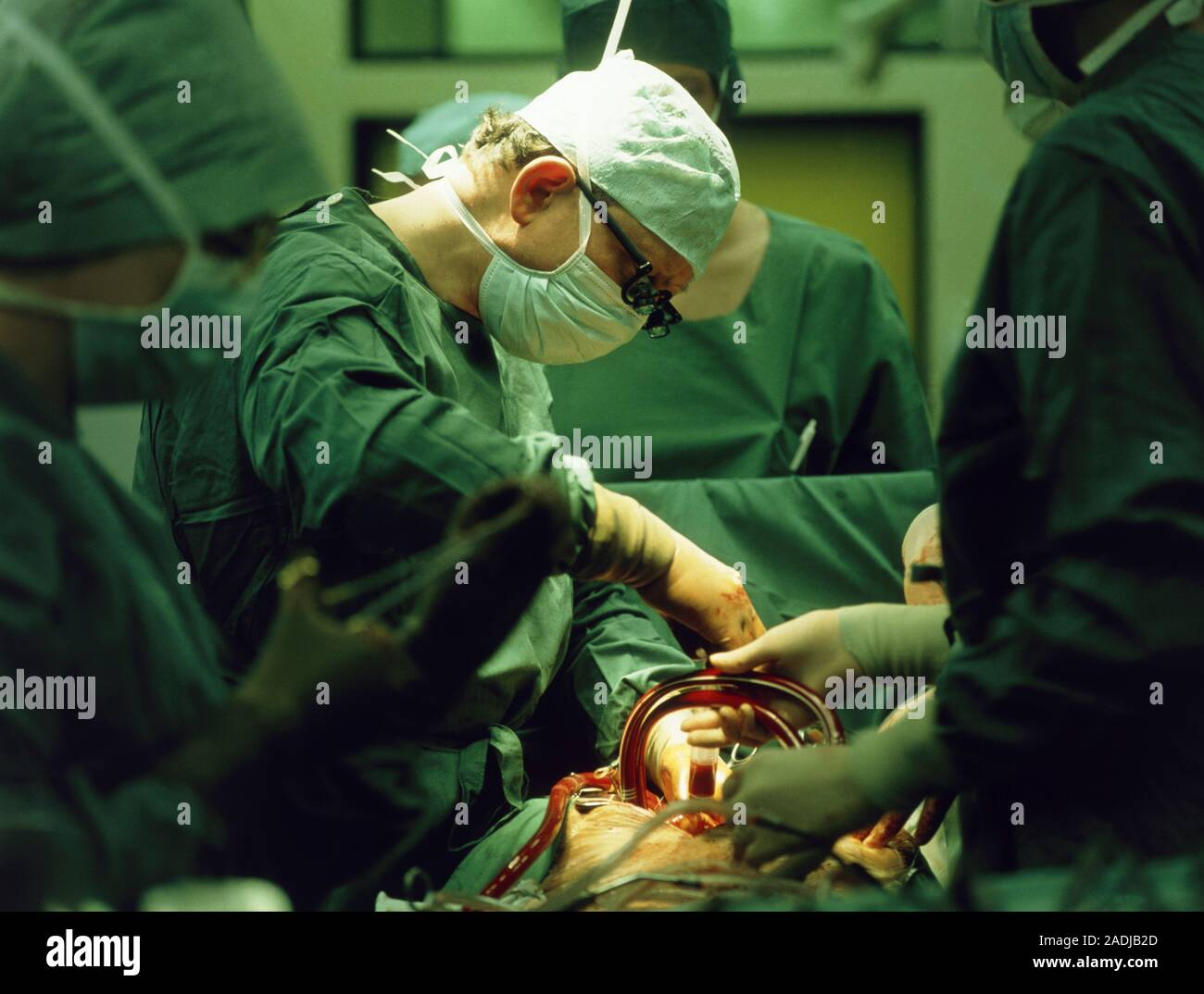 POSED BY MODELS. Heart surgery. Surgical team carrying out open heart ...