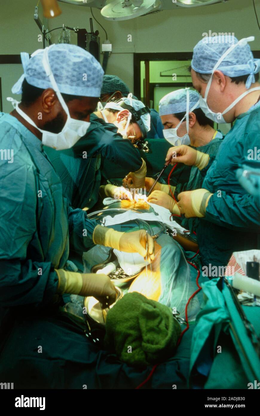 Heart surgery. Surgical team carrying out coronary artery bypass ...