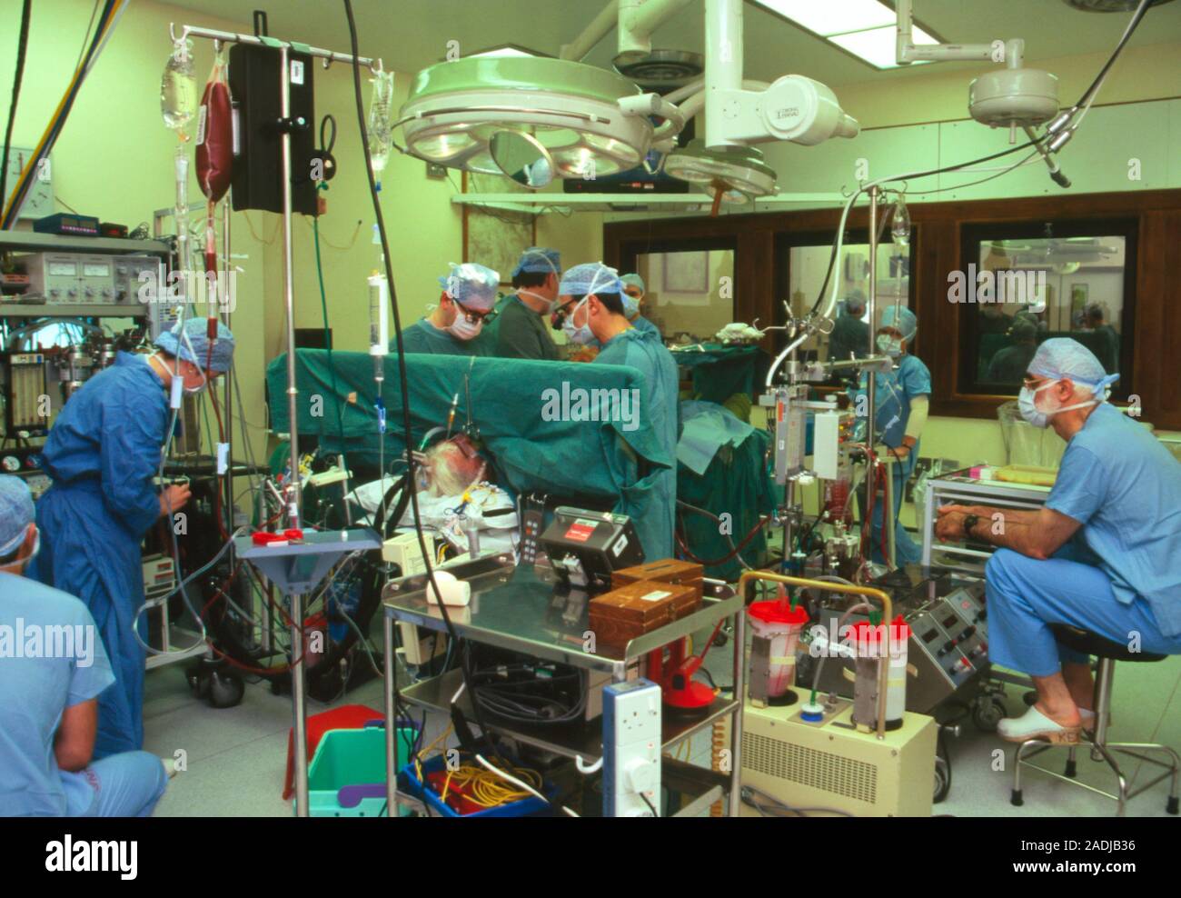 Heart bypass surgery. Operating theatre during a coronary artery bypass ...