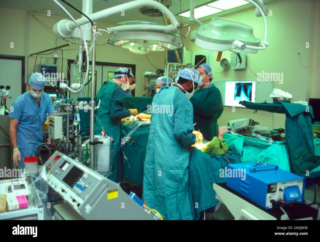 Heart bypass surgery. Operating theatre and surgical team during a ...