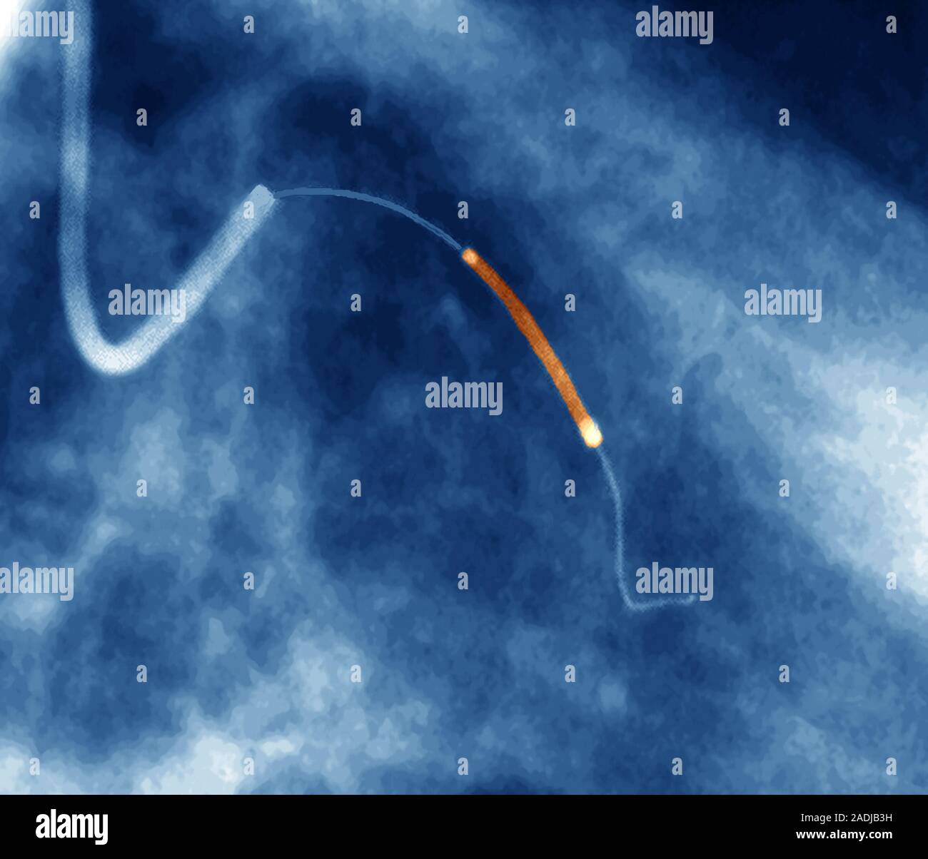 Coronary angioplasty. Coloured X-ray angiogram of a balloon catheter ...