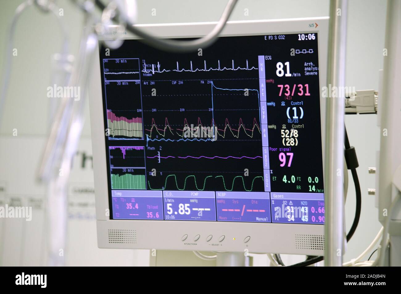 Surgery monitor being used during heart surgery. This displays the ...