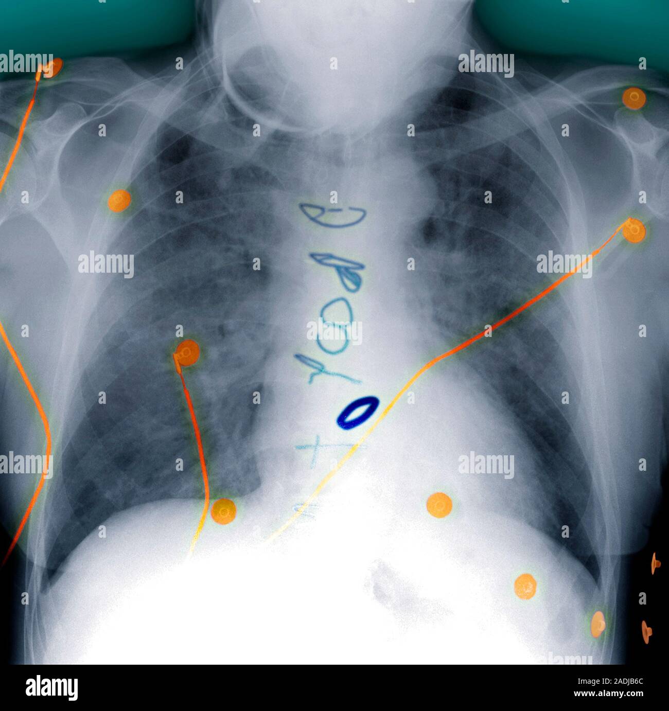 Heart surgery. X-ray of a patient's chest after surgery to replace the ...