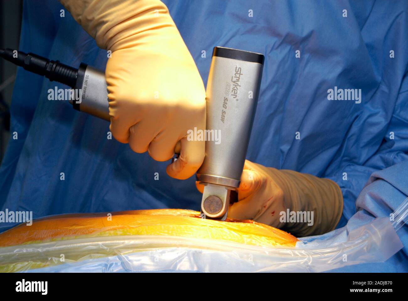 Heart surgery. Image 2 of 24. Surgeon using an electric saw to open a ...