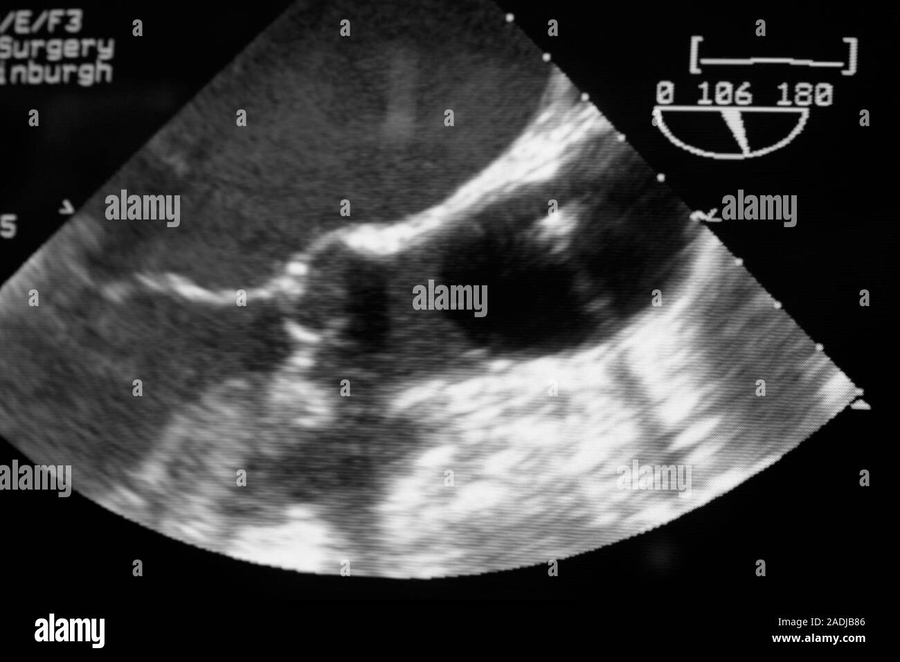 Heart valve surgery. Transoesophageal echo (TOE) ultrasound scan of the ...