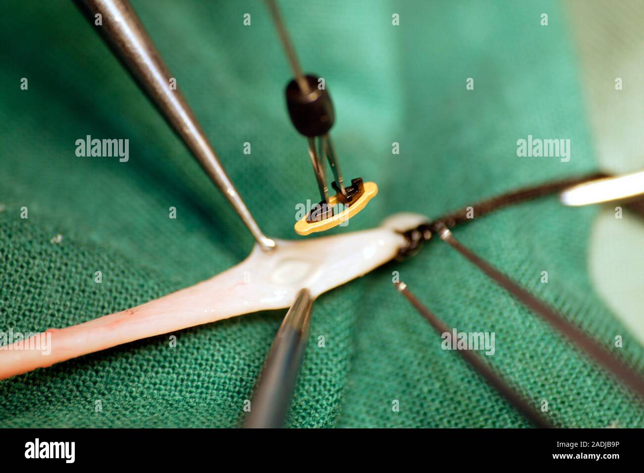 Heart bypass surgery. Image 3 of 18. Part of a magnet being inserted ...