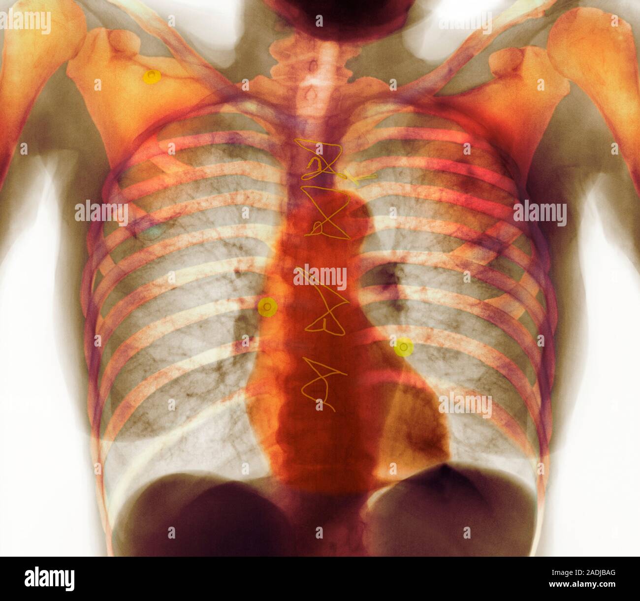 Heart after surgery. Coloured X-ray of the chest of an elderly woman ...