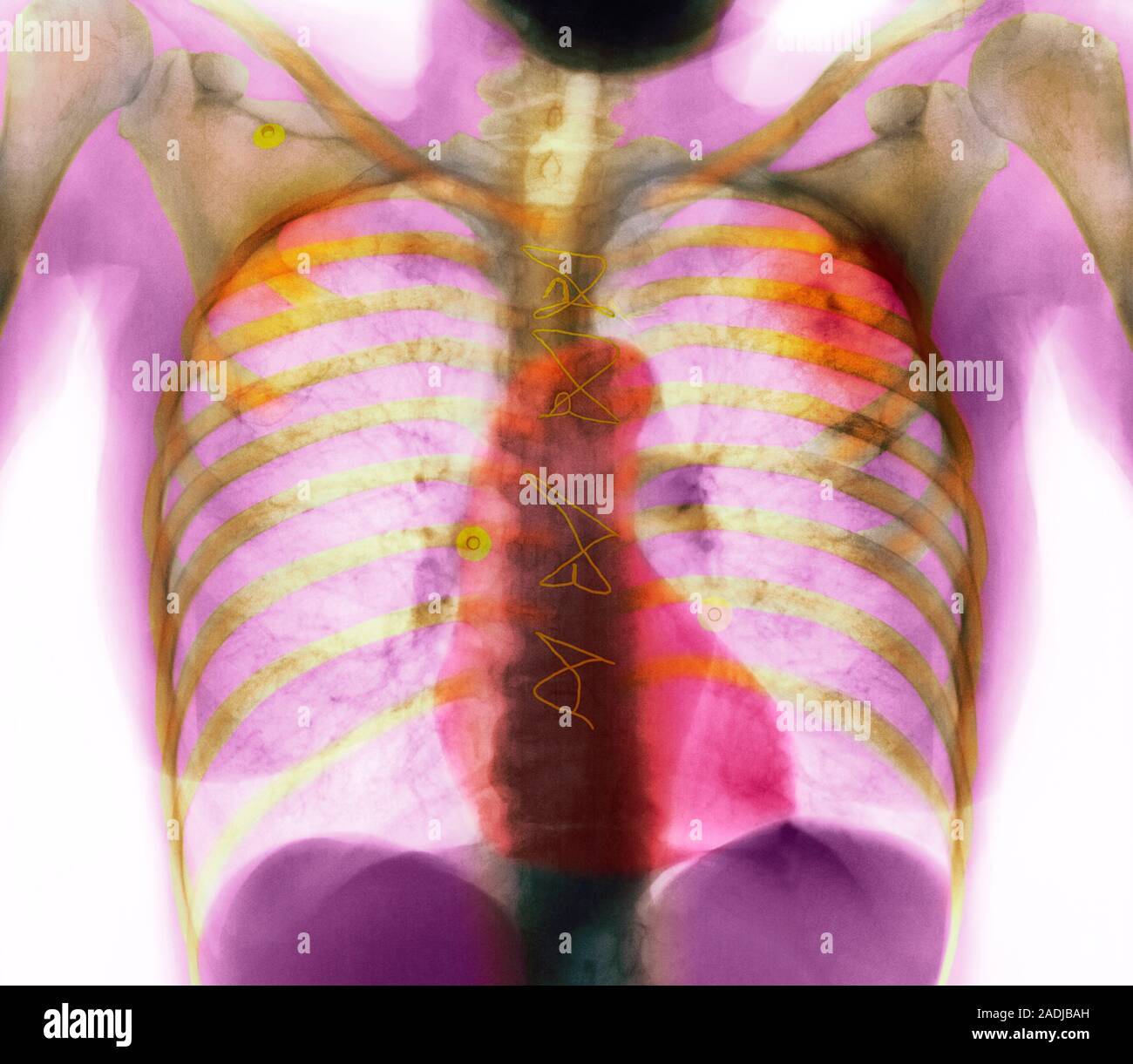 Heart after surgery. Coloured X-ray of the chest of an elderly woman ...