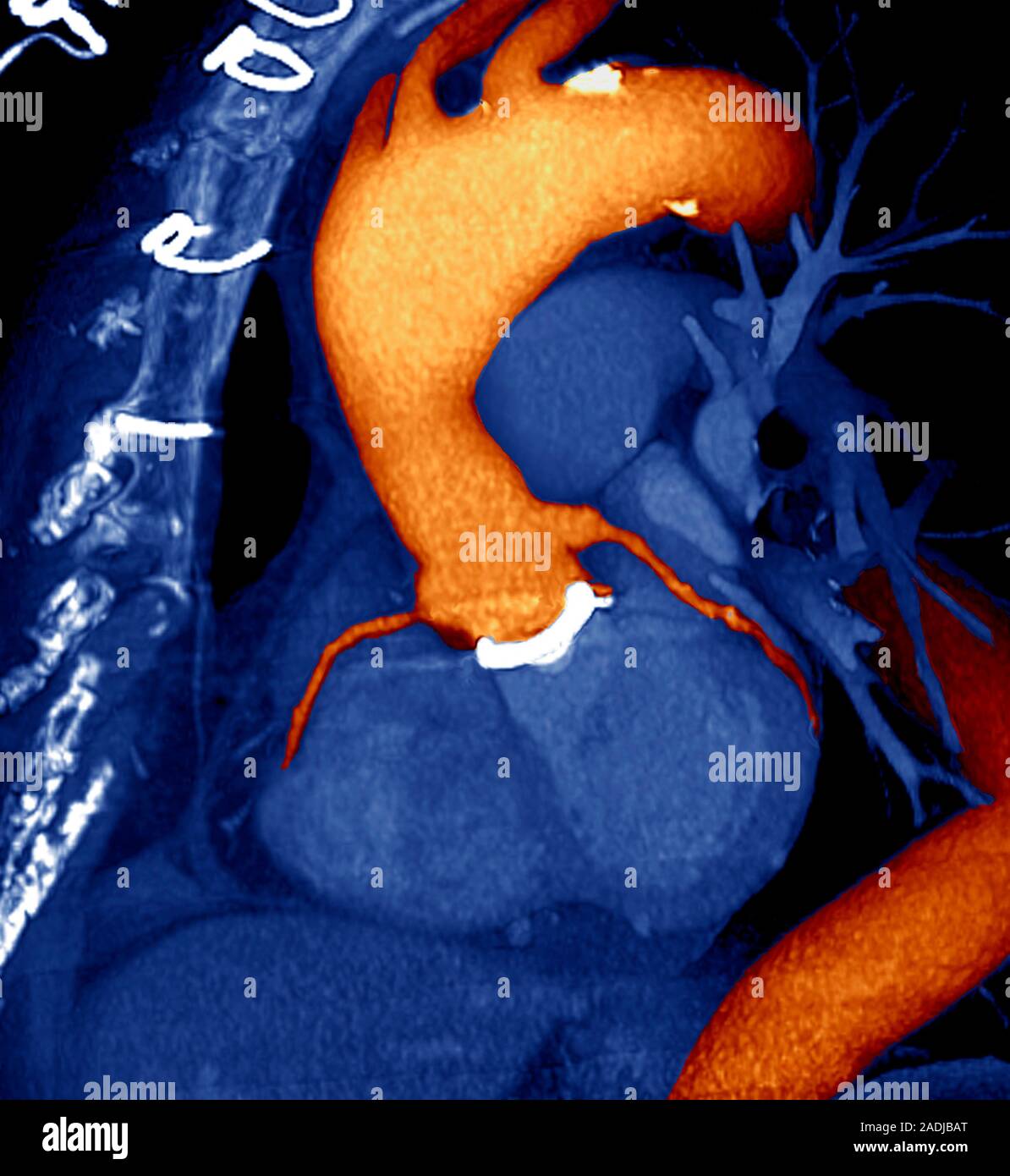 Prosthetic heart valve. Coloured 3D CT (computed tomography) scan of a 70-year-old patient's ...