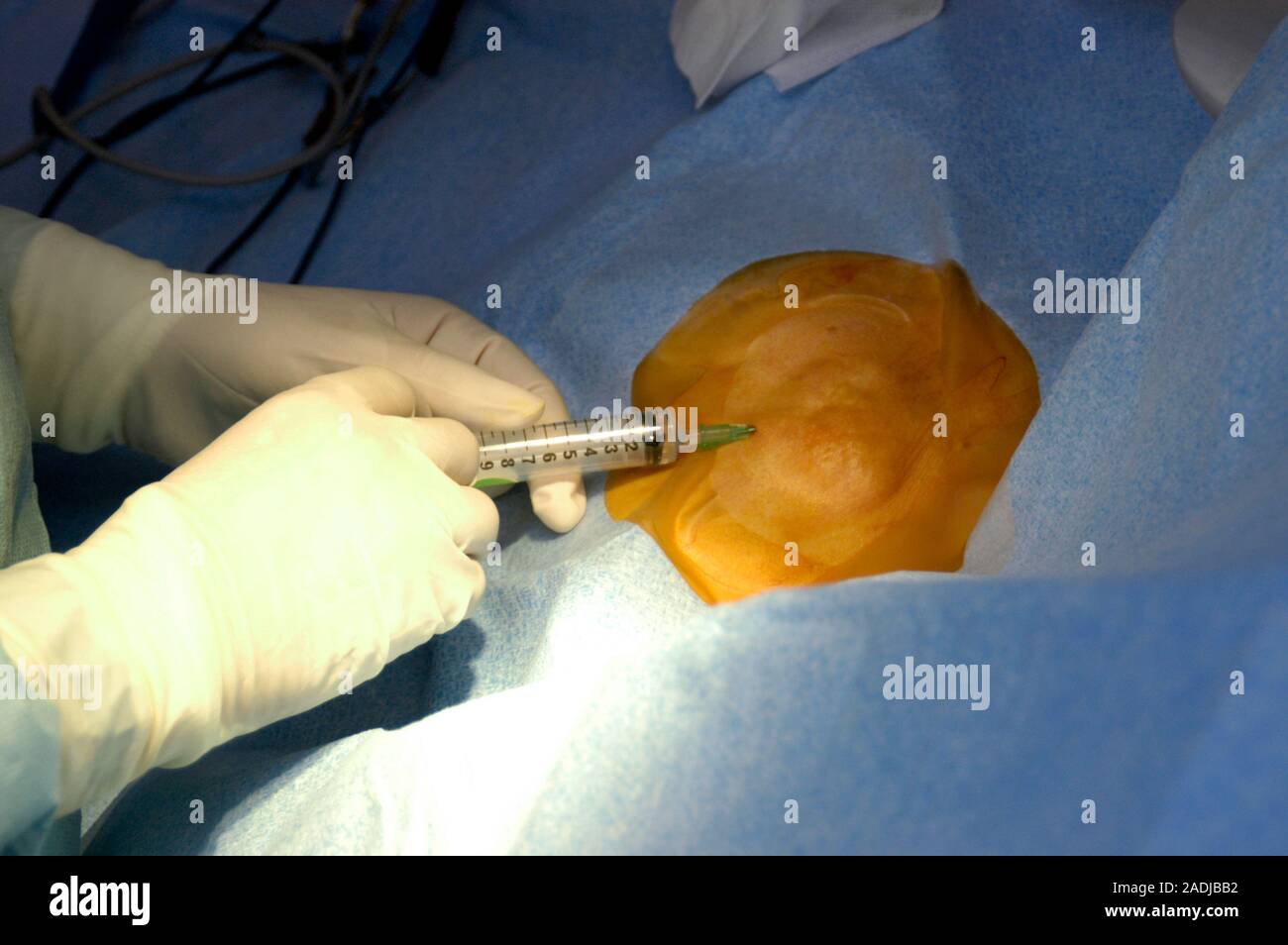 MODEL RELEASED. Heart pacemaker surgery. Image 2 of 9. Close-up of ...