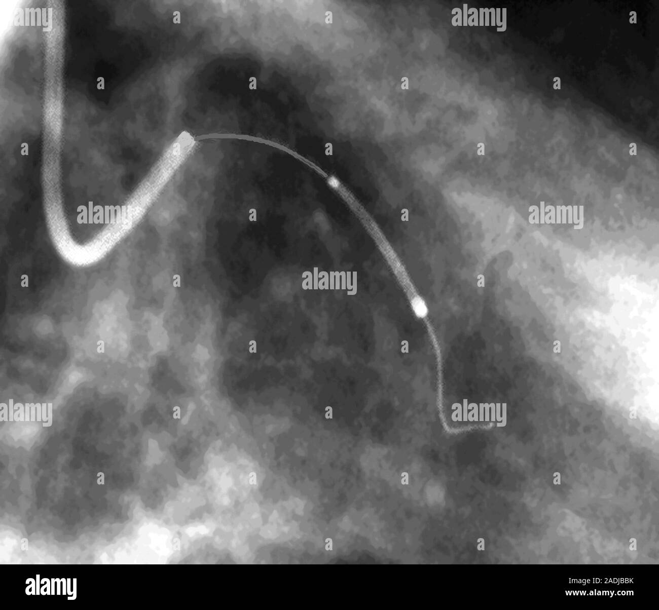 Coronary angioplasty. X-ray angiogram of a balloon catheter and stent ...