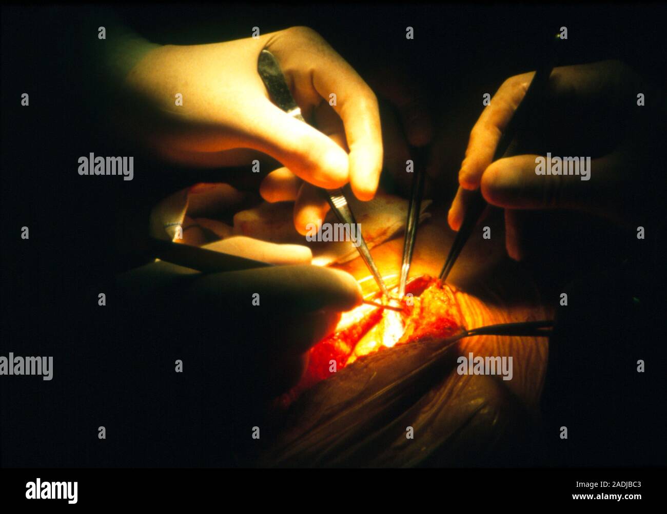 Heart implant surgery (image 11 of 12). Surgeons' gloved hands using a ...
