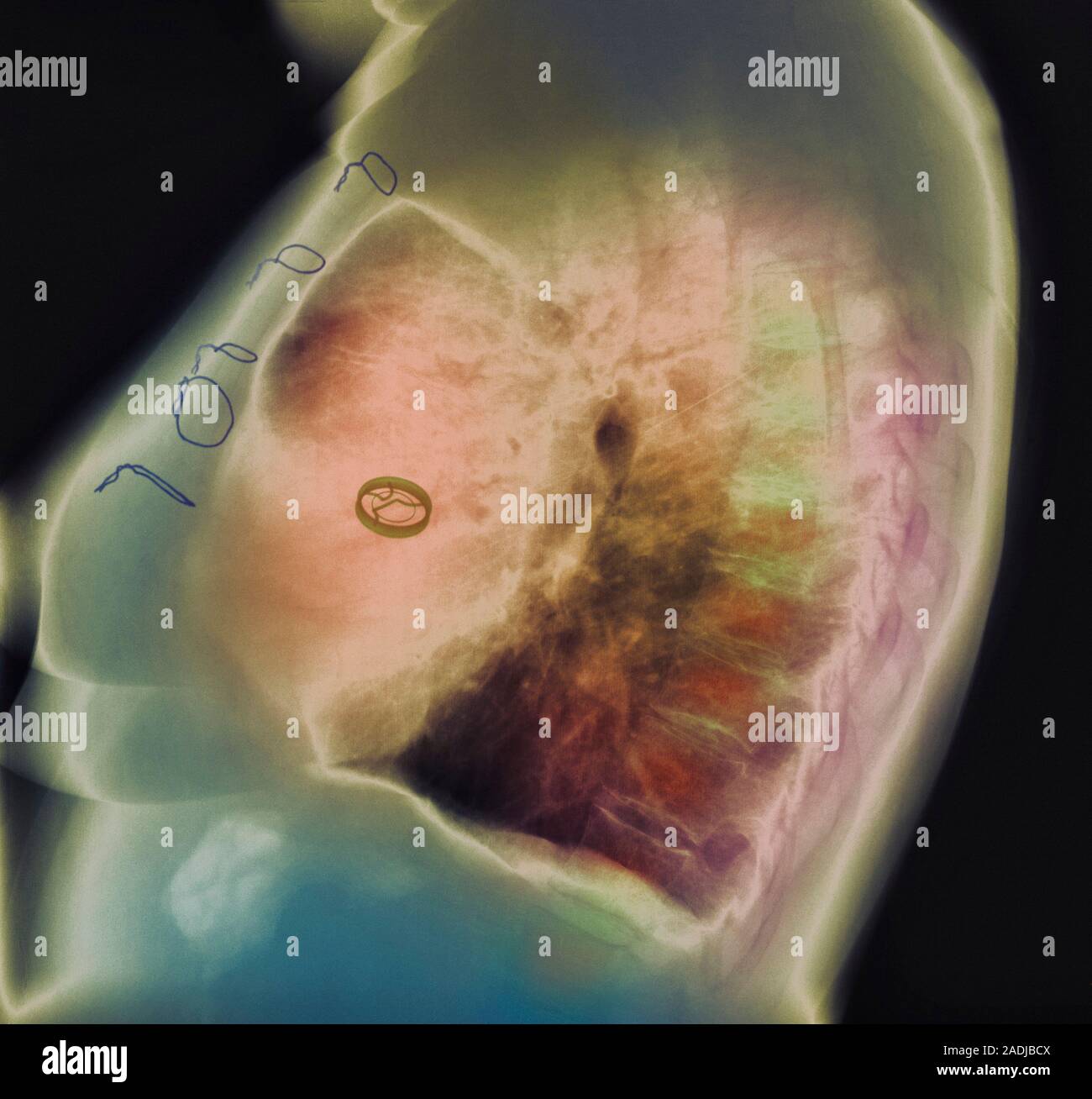 Heart valve replacement. Coloured chest X-ray of a female patient (side ...