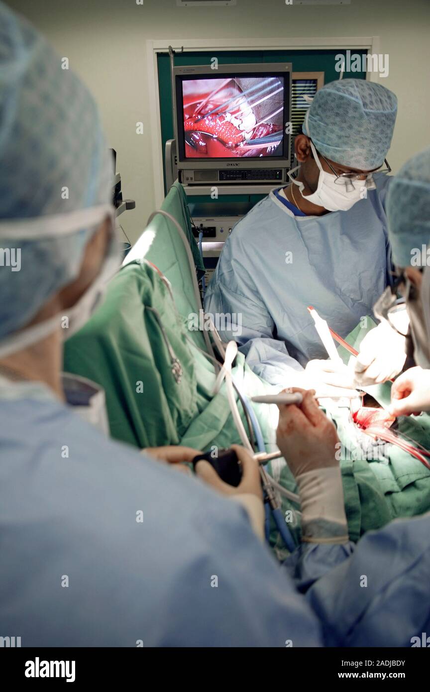 Heart valve surgery. Surgeons carrying out keyhole heart surgery to ...