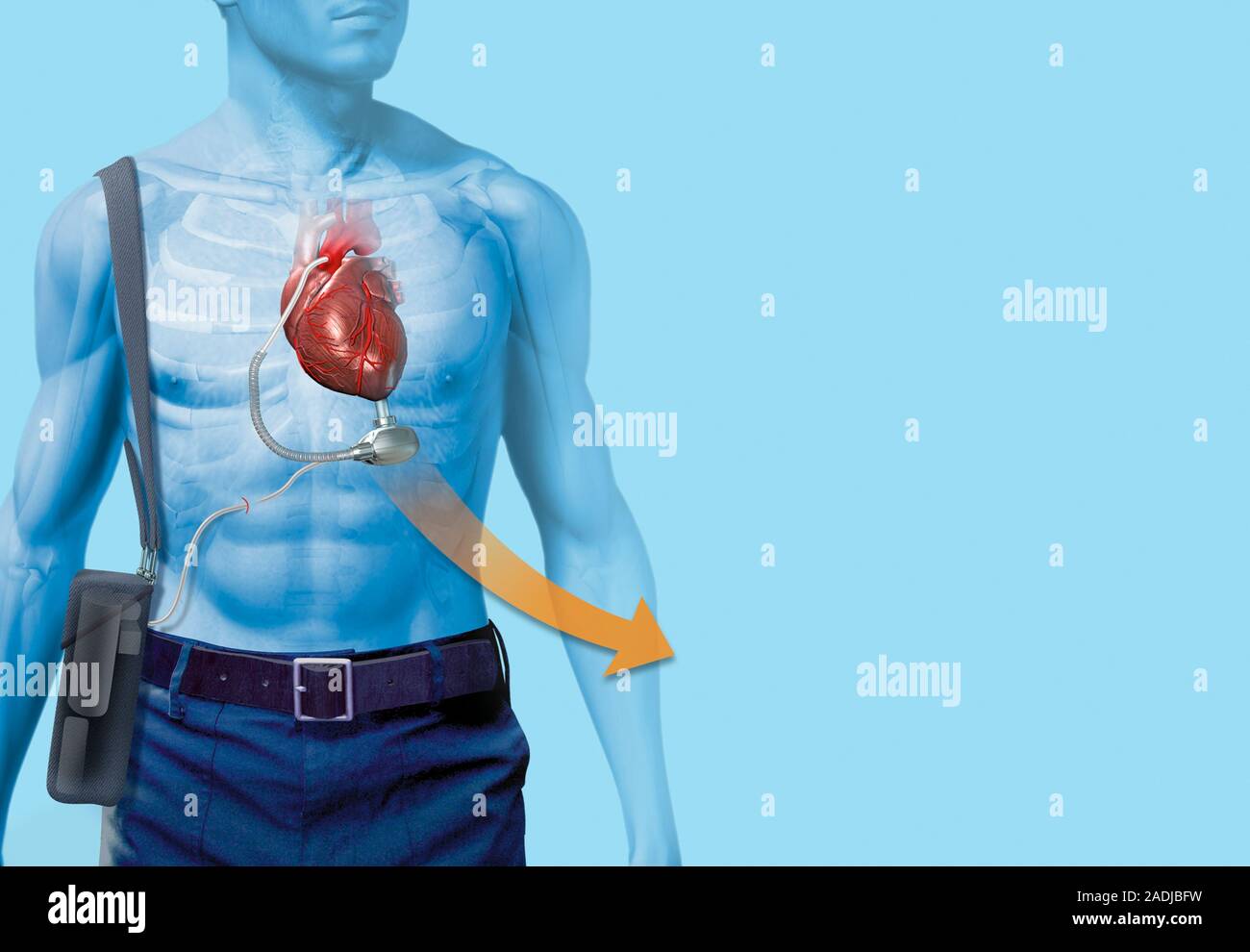 Mechanical heart pump. Artwork of a man with a left ventricular assist ...