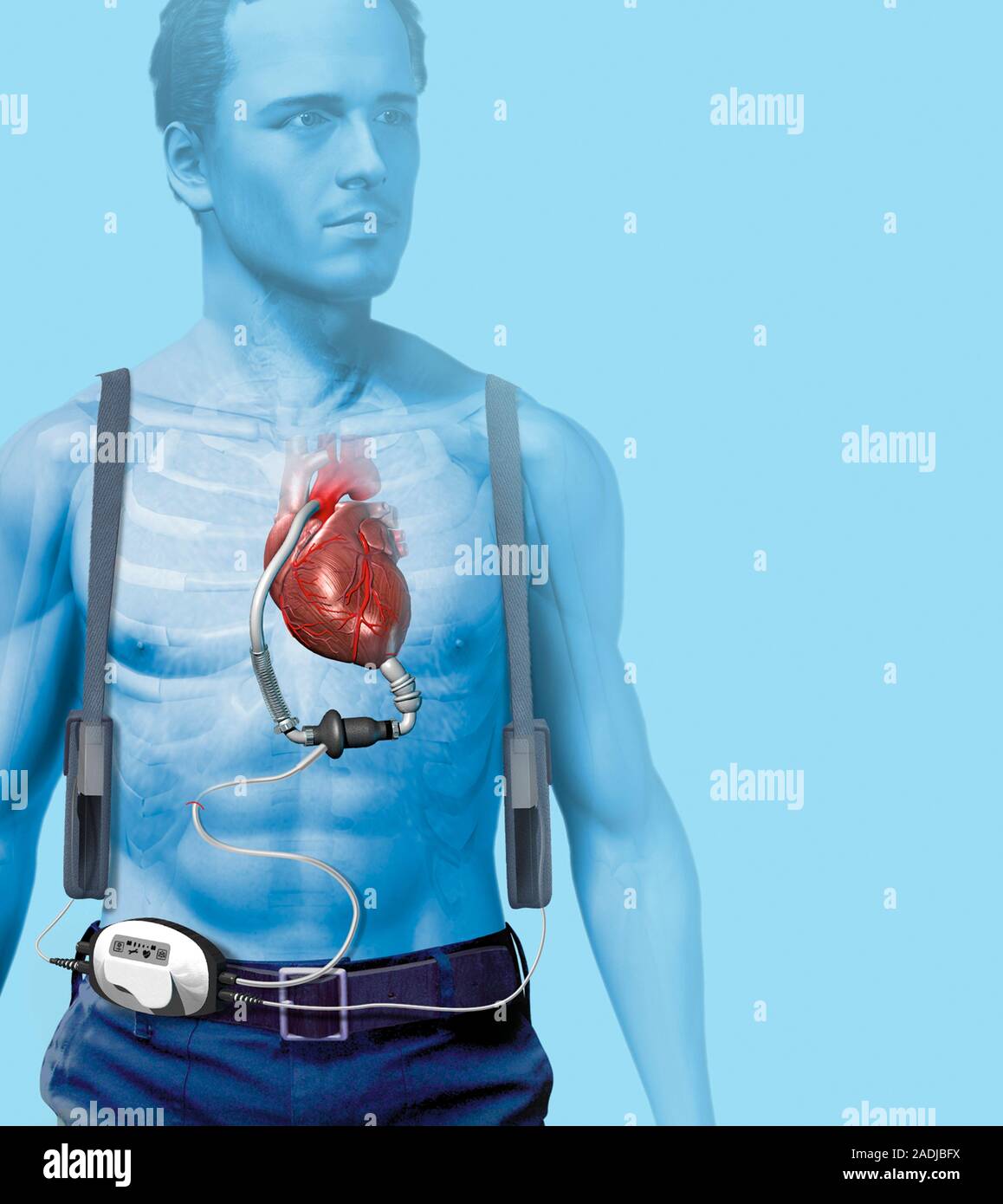 Mechanical heart pump. Artwork of a man with a left ventricular assist ...