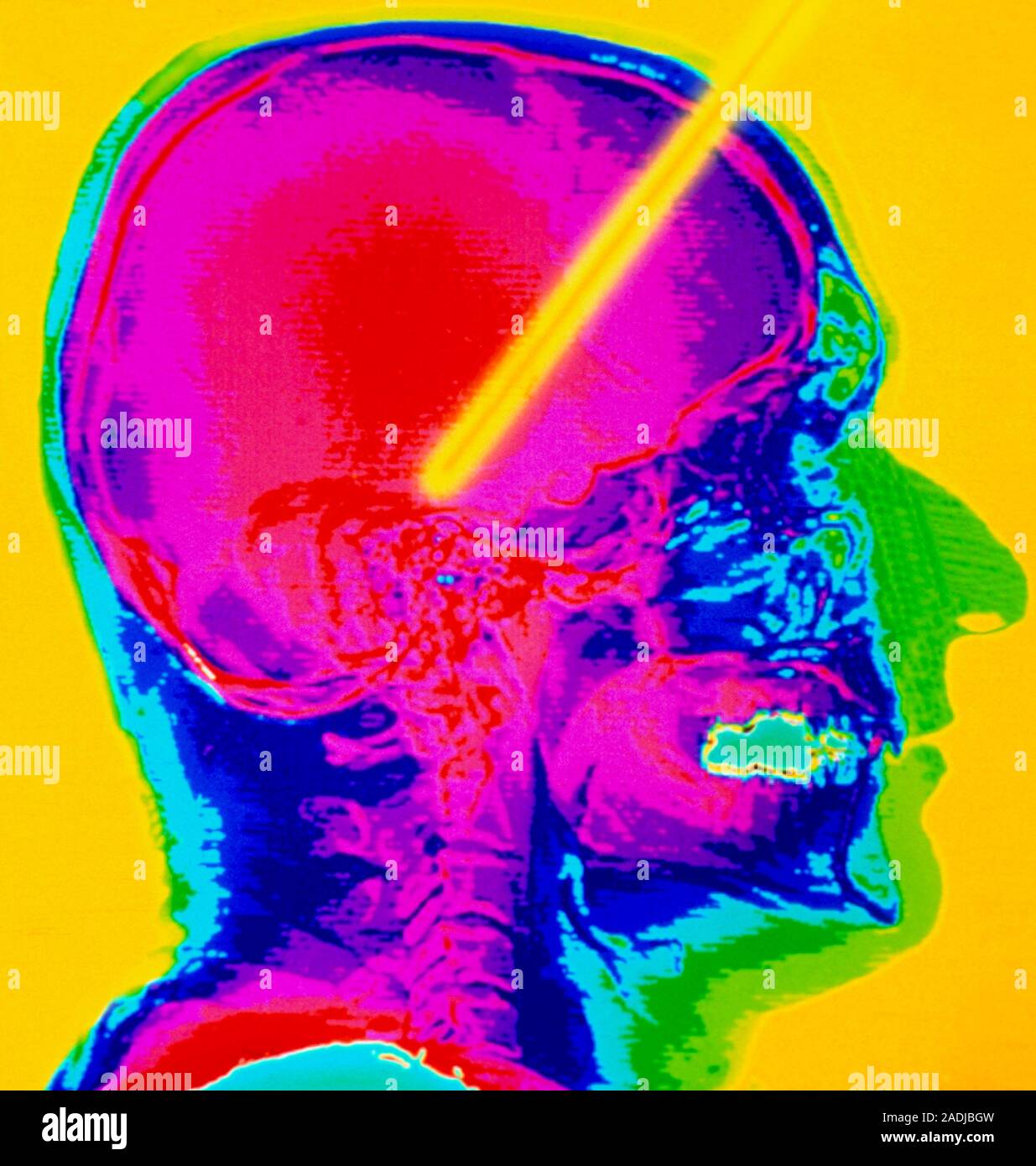 Parkinson's surgery. Coloured computed tomography (CT) scan of a ...