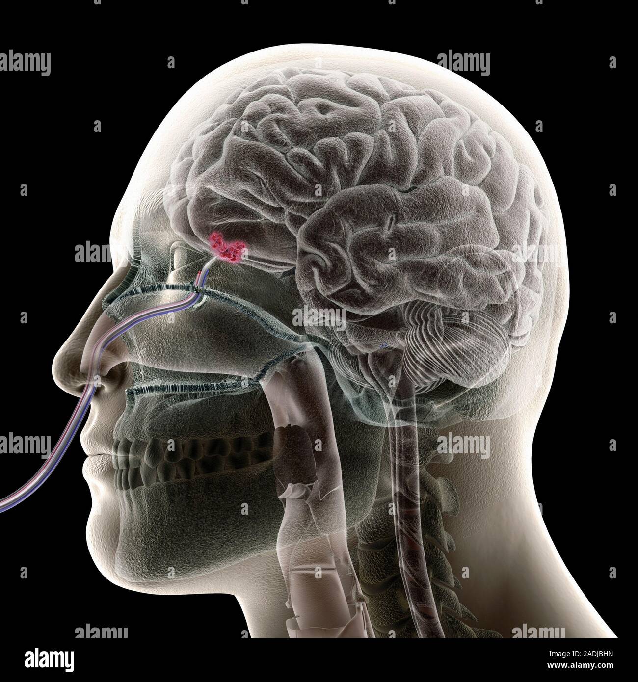 Transnasal brain surgery. Computer artwork of a person undergoing ...