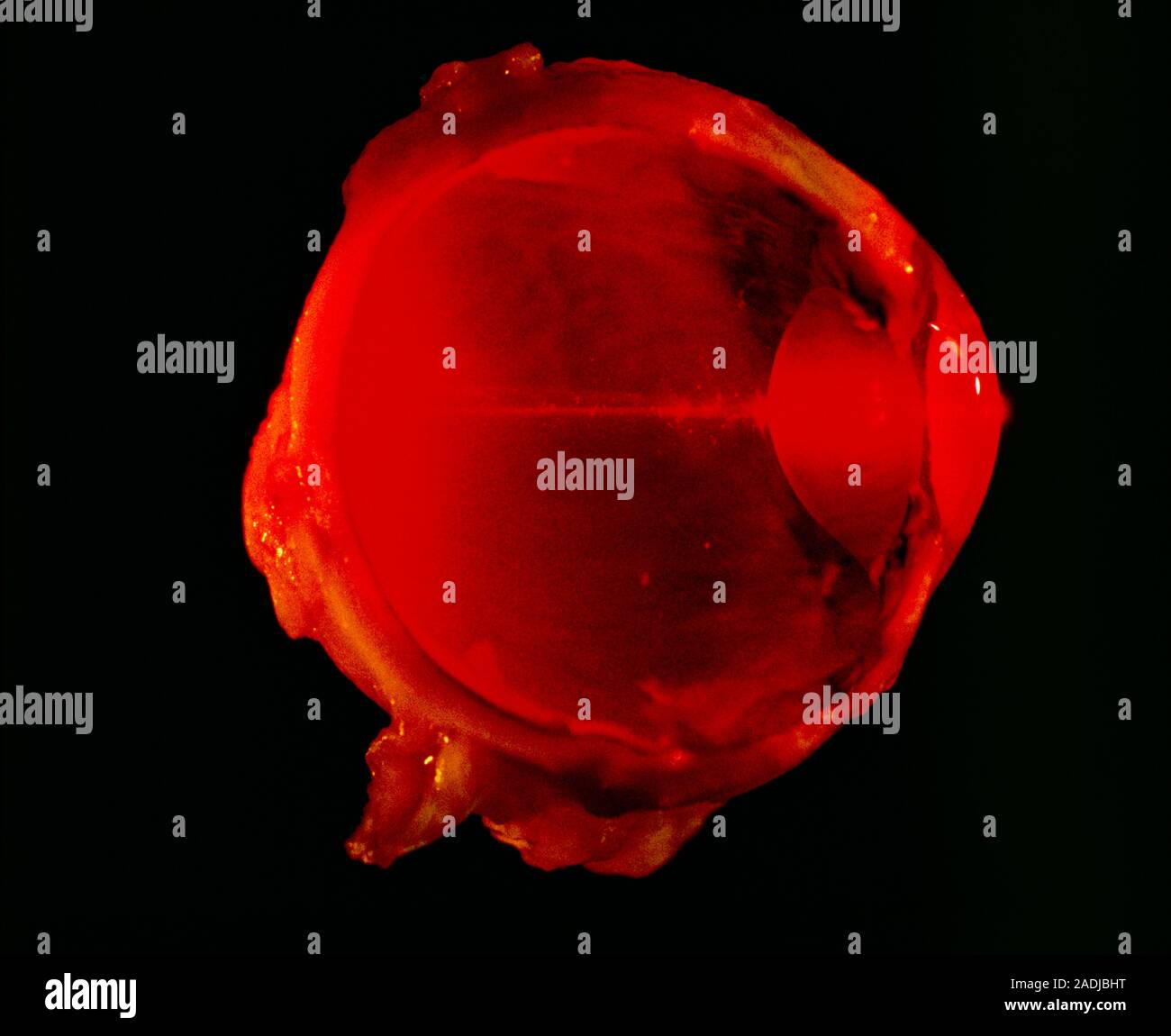 Demonstration of laser technique to repair damaged retina of eye. The ...