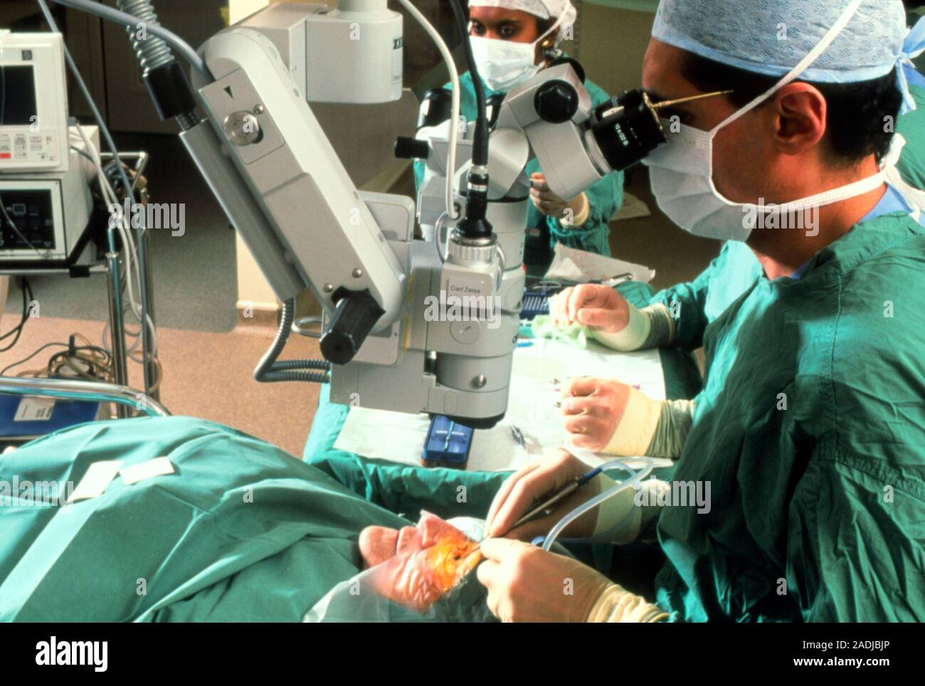 Cataract surgery. Surgeon performs cataract extraction on a patient's ...
