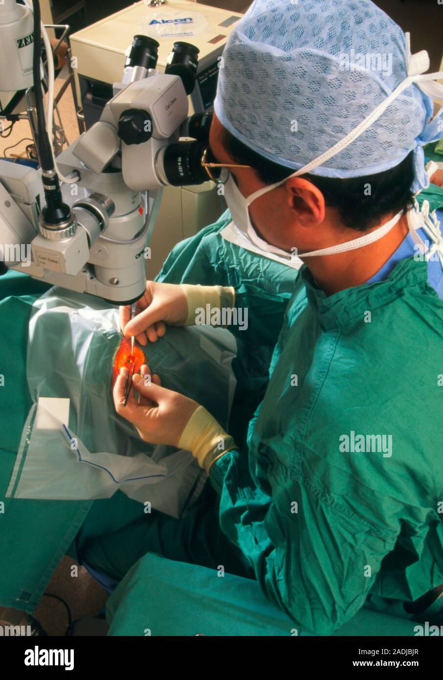 Trabeculectomy. Surgeon performs a trabeculectomy, an operation to ...