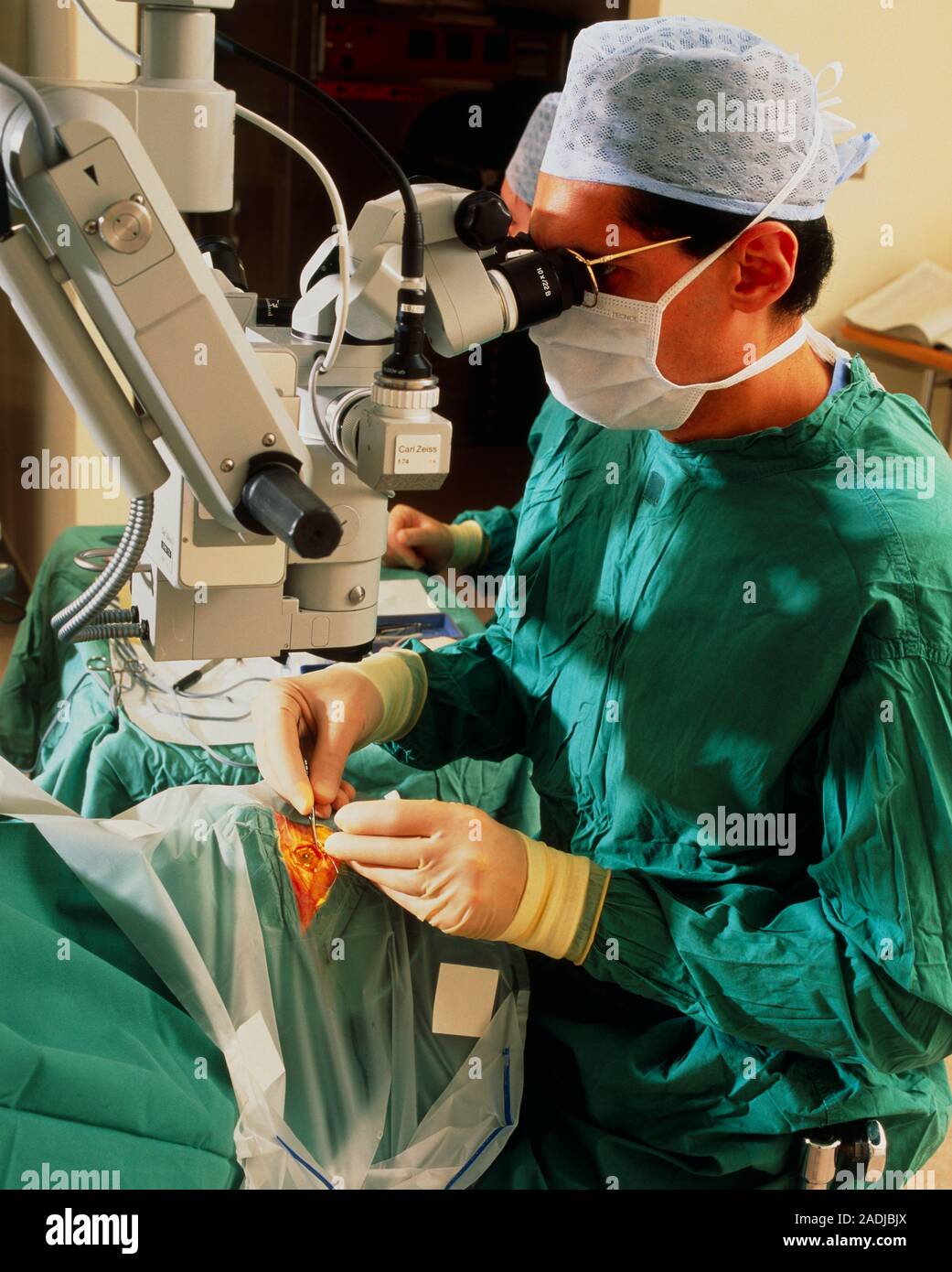Trabeculectomy. Surgeon performs a trabeculectomy, an operation to ...