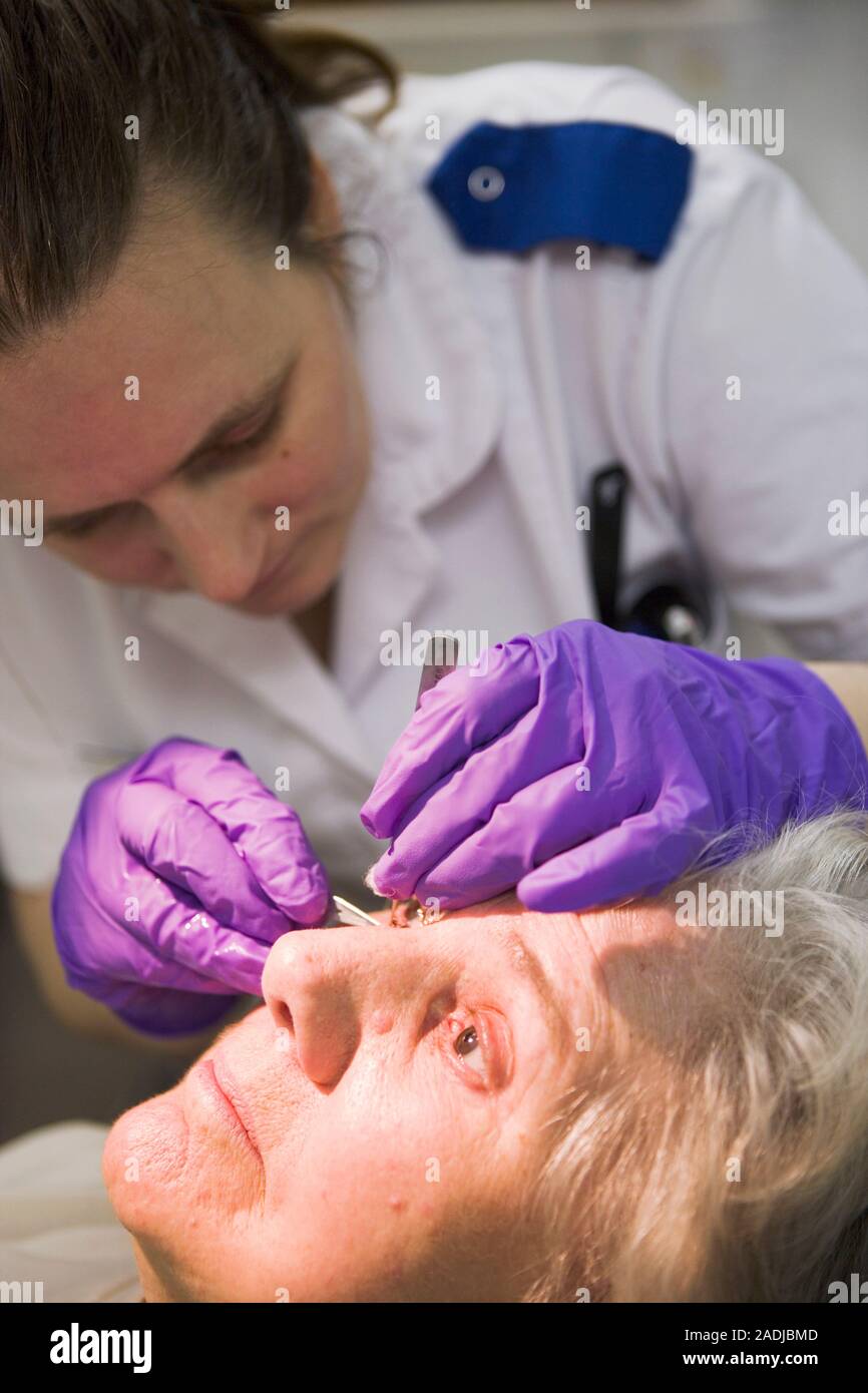 MODEL RELEASED. Eye surgery. Nurse removing sutures from a patient's ...