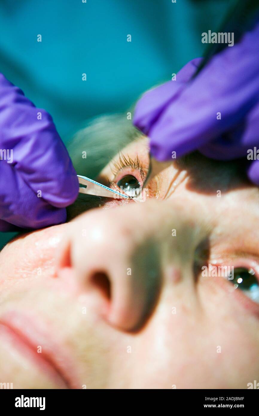 MODEL RELEASED. Eye surgery. Nurse removing sutures from a patient's ...