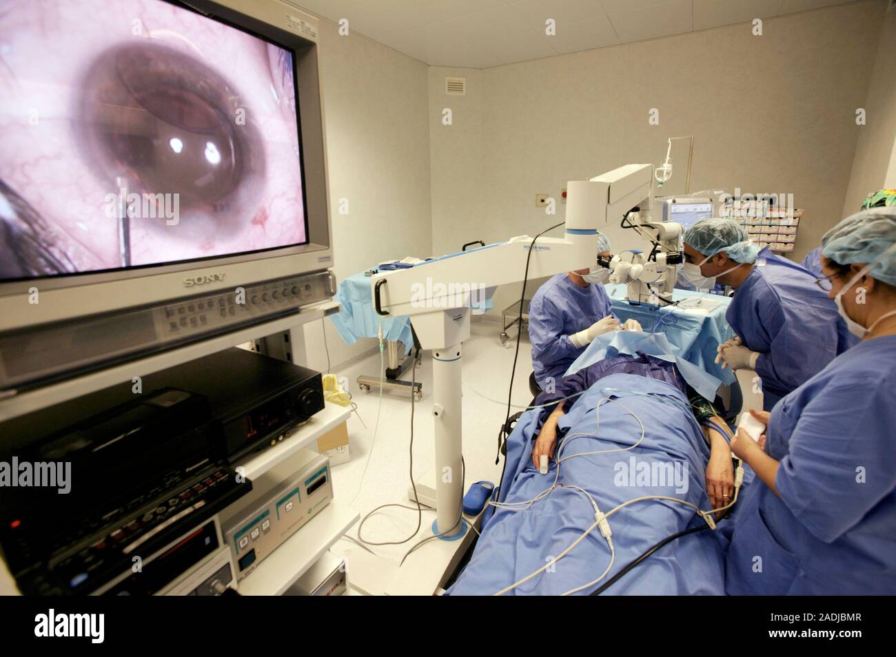 MODEL RELEASED. Cataract surgery. Surgeons using microscopes during ...