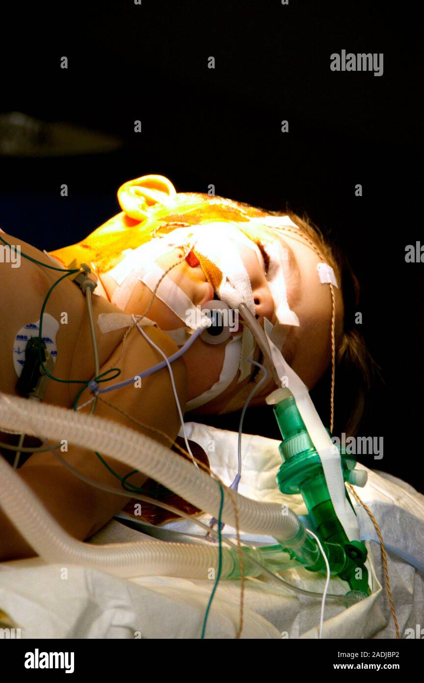Cochlear implant surgery. Head of a 5-year-old girl undergoing surgery ...