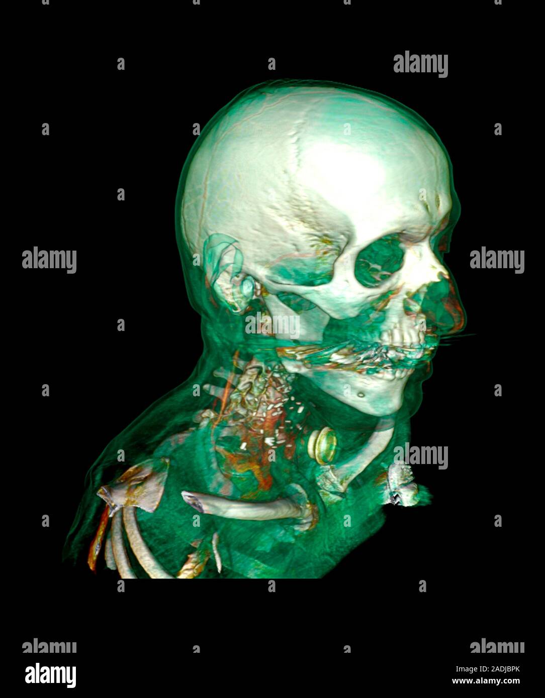 Tracheostomy, CT scan. Coloured 3-D computed tomography (CT) scan of a ...
