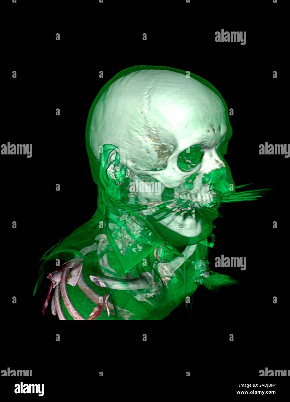 Tracheostomy, CT scan. Coloured 3-D computed tomography (CT) scan of a ...