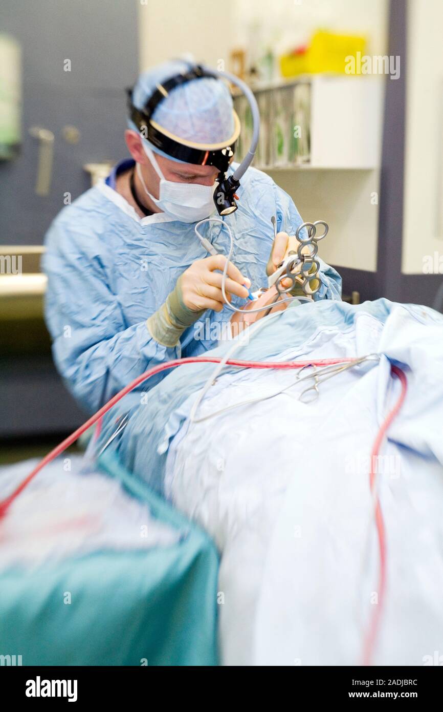 Tonsillectomy. Surgeon performing a tonsillectomy (tonsil removal ...