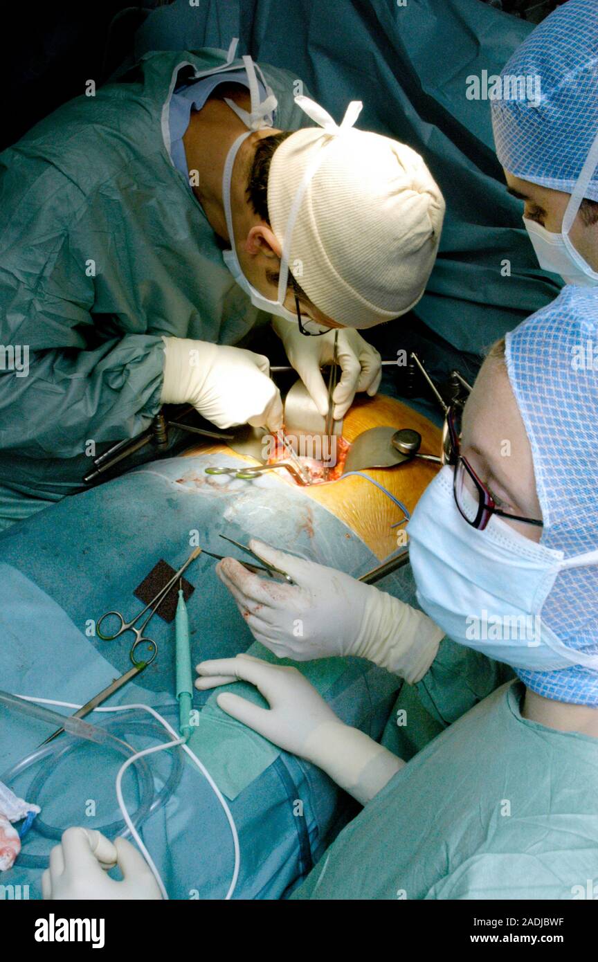 MODEL RELEASED. Kidney transplant. Image 17 of 17. Surgeons performing ...