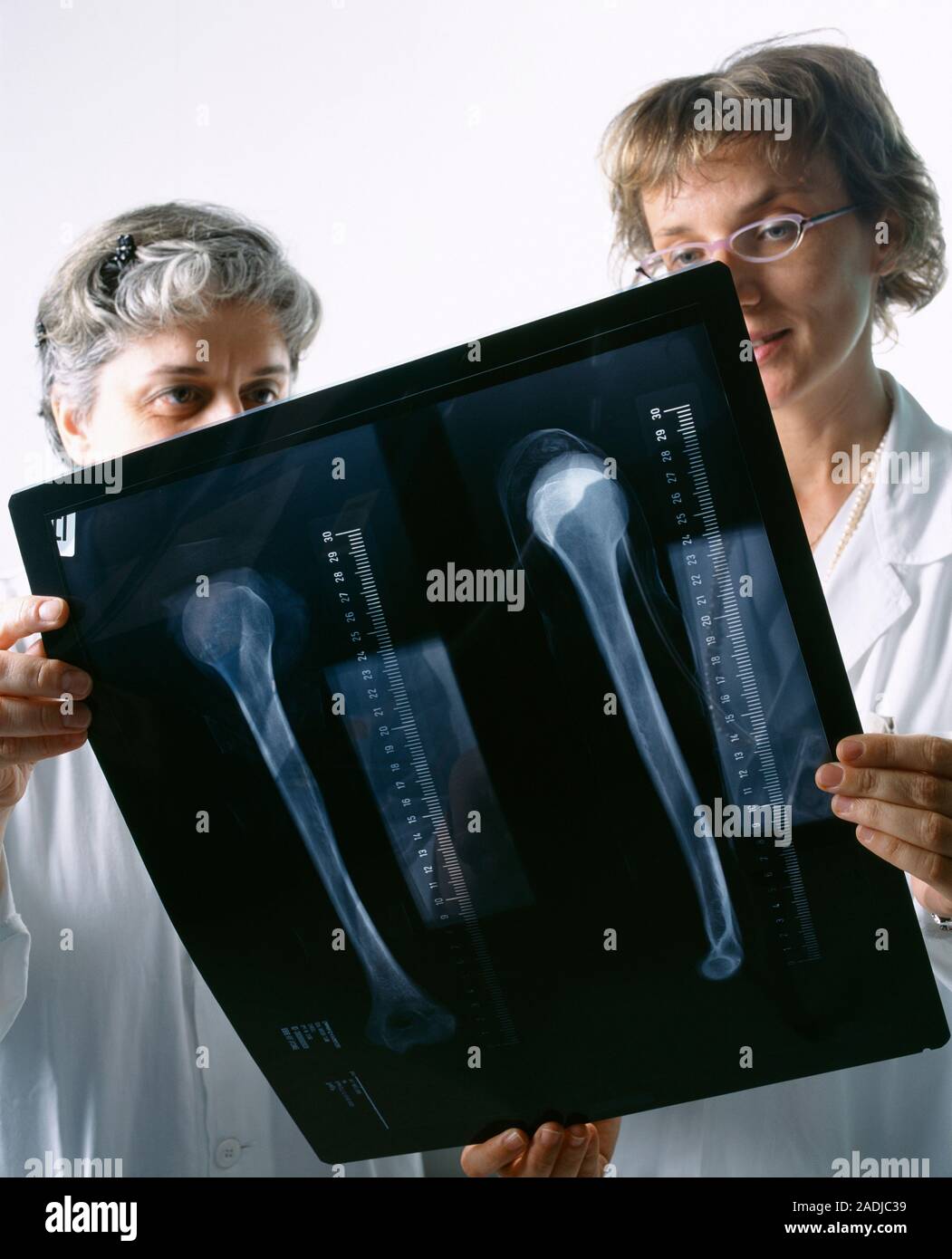 Bone bank screening. Doctors look at an X-ray of bones donated to a ...