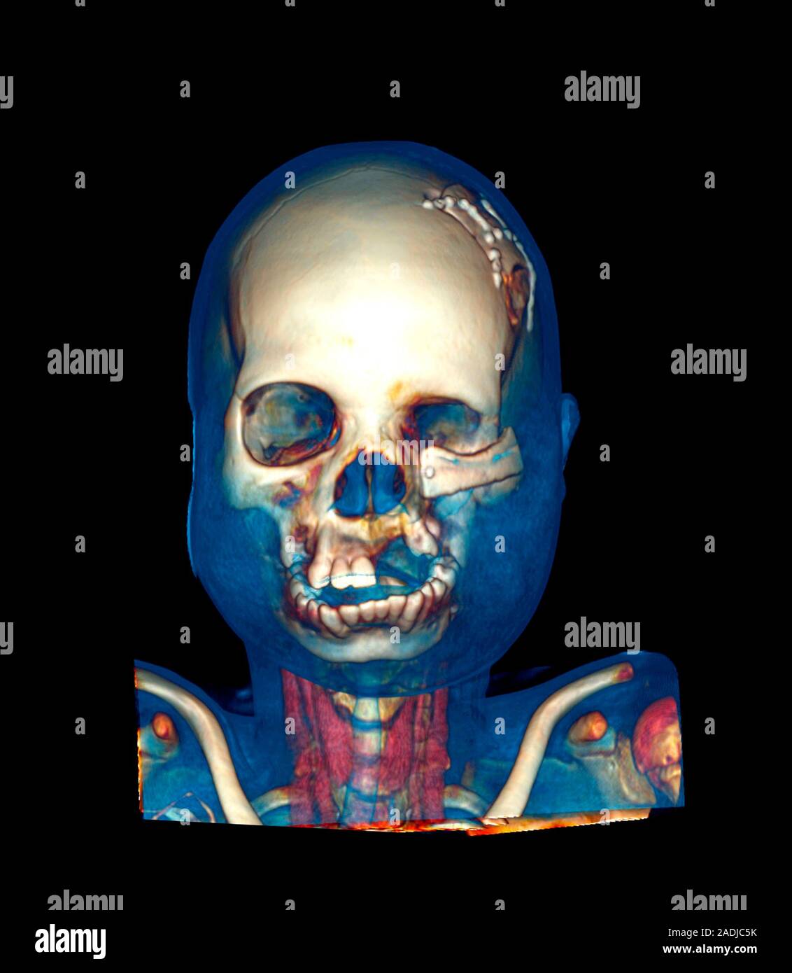 Facial reconstruction, CT scan. Coloured 3-D computed tomography (CT ...