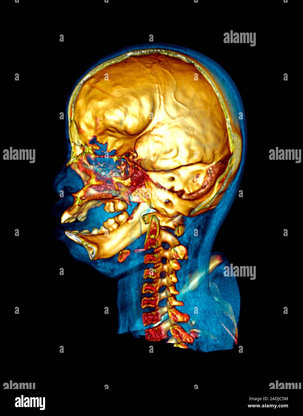 Facial reconstruction, CT scan. Coloured 3-D computed tomography (CT ...