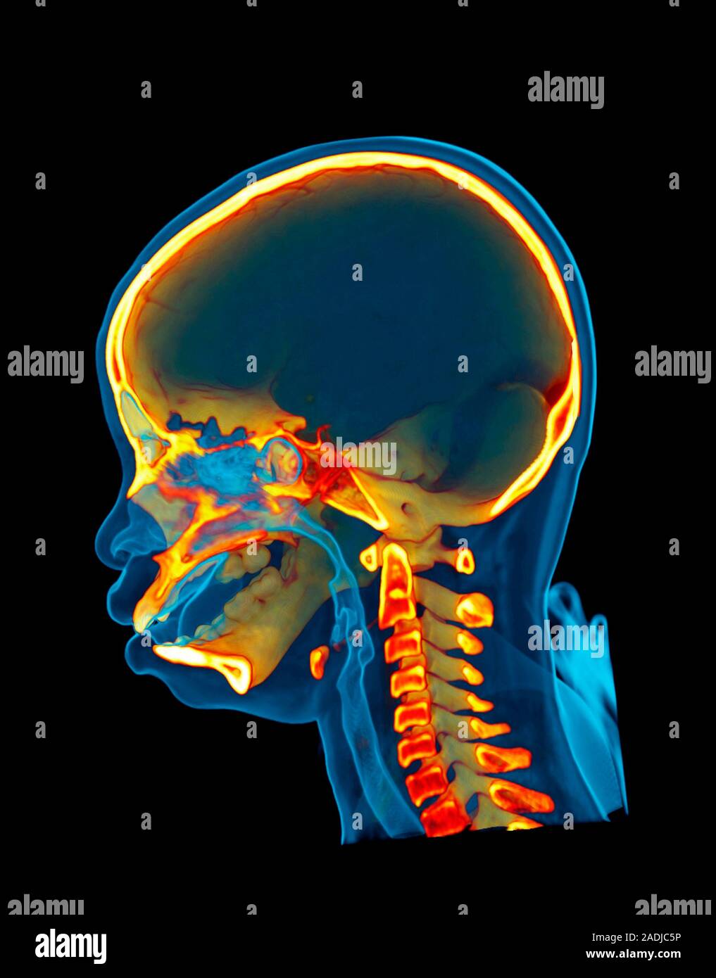 Facial reconstruction, CT scan. Coloured 3-D computed tomography (CT ...