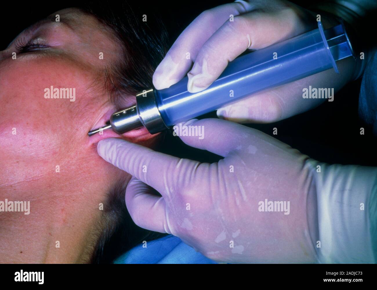 Cheek liposuction. Surgeon's gloved hands using a syringe to remove fat ...