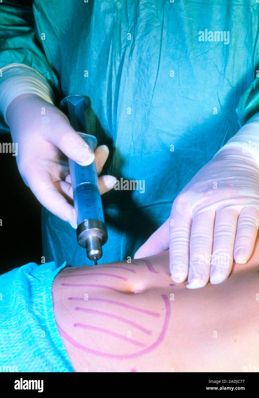 Abdominal liposuction. Surgeon using a syringe to remove fat from a ...